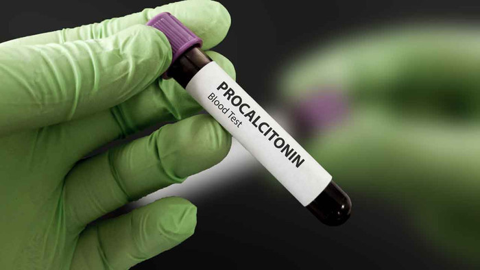 Prokalsitonin (PCT) nedir? Prokalsitonin neden bakılır? Prokalsitonin ...